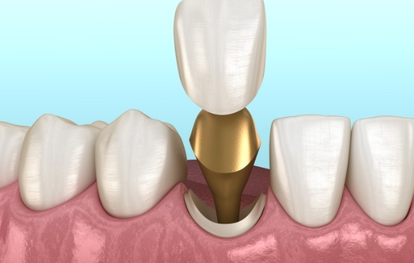 Custom Dental Implants & Abutments